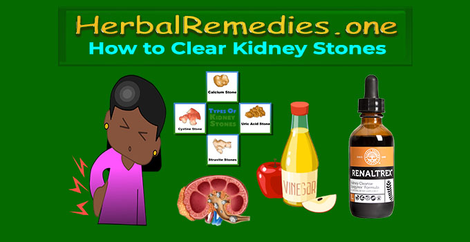 How to Get Rid of Kidney Stones - Herbal Remedies